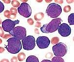 Blood cancers are curable if detected early