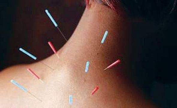 Here's how needle therapy can help treat your text neck