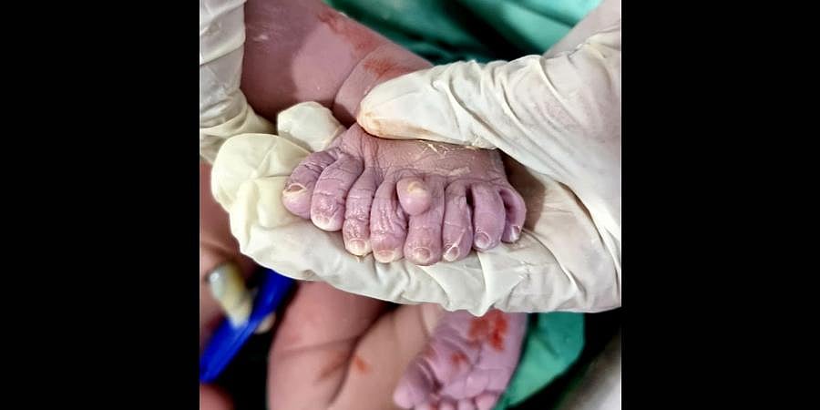 Baby with nine toes on single foot born in Karnataka, family says it's ...