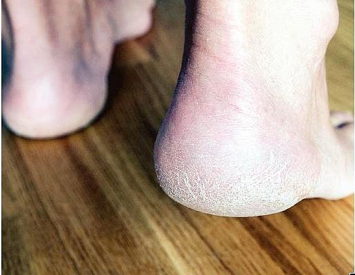 Heal heel cracks with care