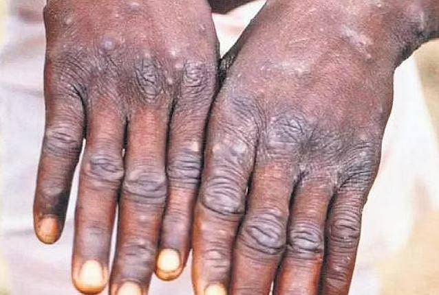 Monkeypox scare: TN district collectors told to raise surveillance