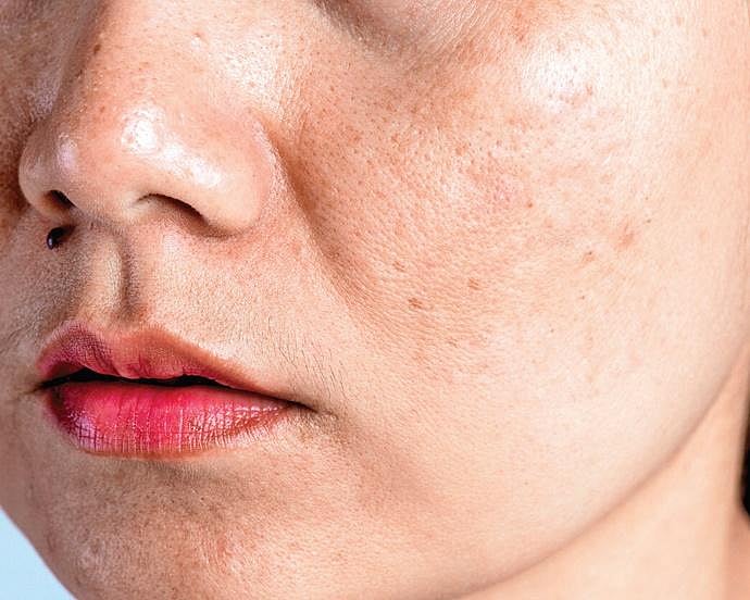 Acne mapping for a healthy skin