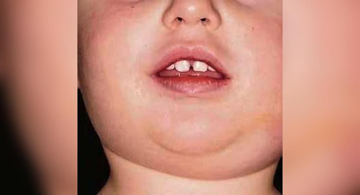 Hyderabad doctors report surge in mumps cases
