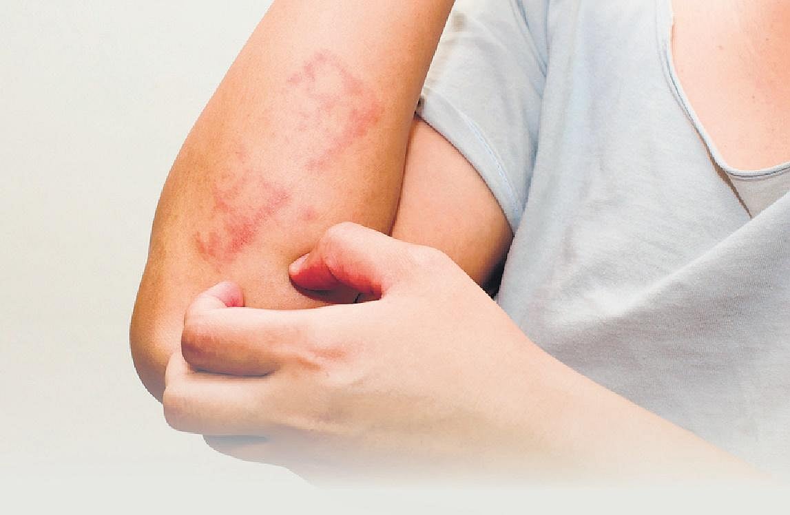 Overcoming allergies