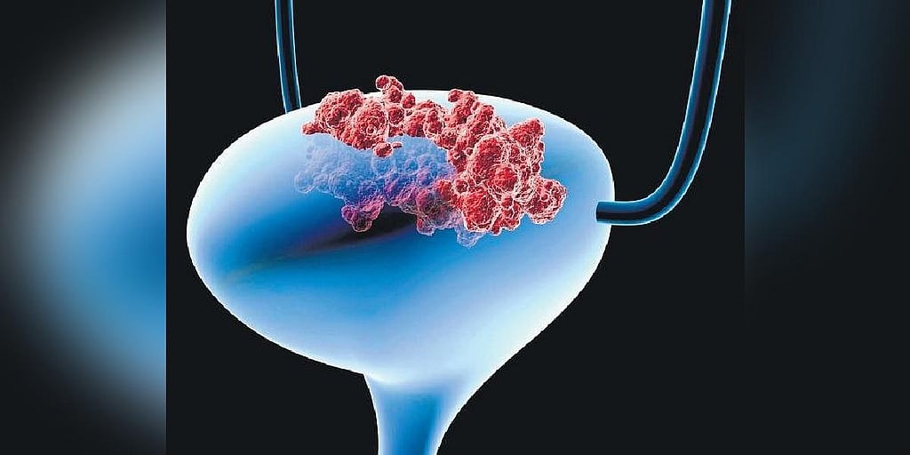 Bladder cancer: New techniques improve treatment outcome