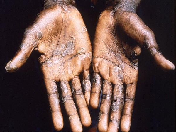 Mpox outbreak in Africa was neglected – it could now turn into the next ...