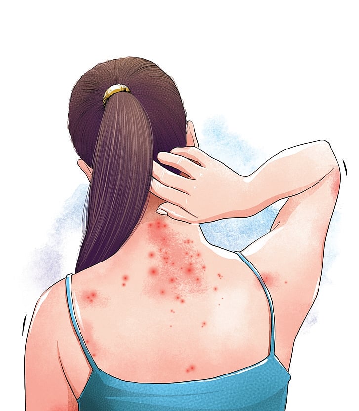 Seasonal allergies surge in Telangana, doctors advise precautionary ...
