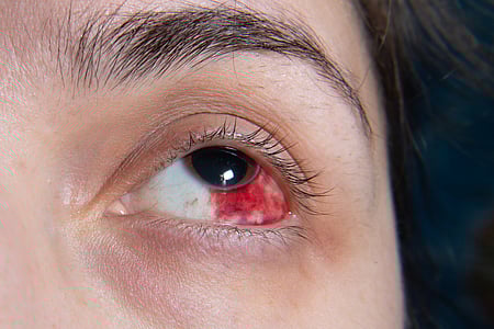 Redness of eyes can also be due to corneal ulcer or glaucoma
