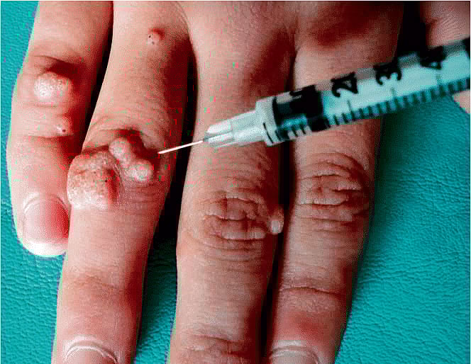 Warts: A common skin problem that is often ignored